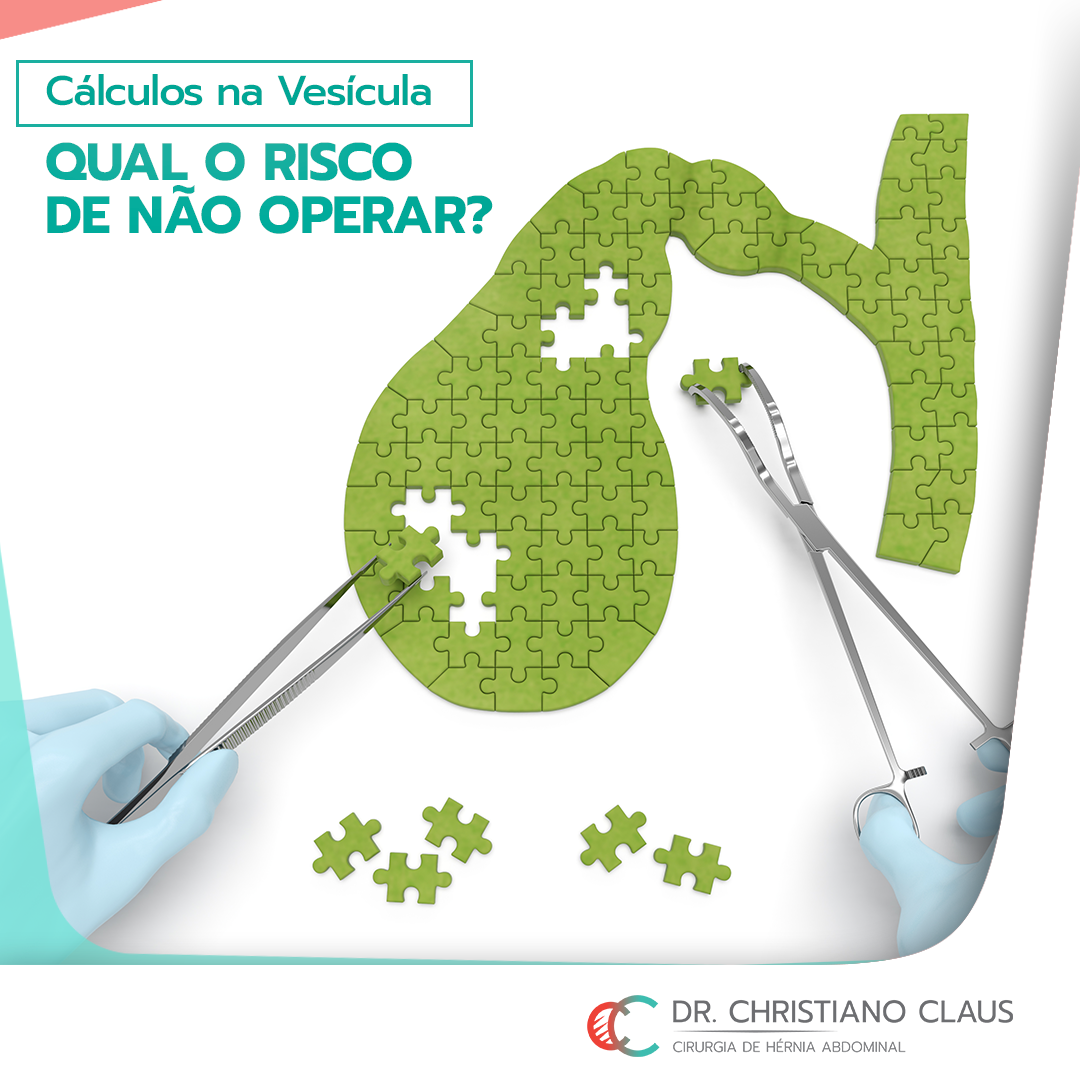 Cálculos na vesícula: qual o risco de não operar? – Dr. Christiano Claus
